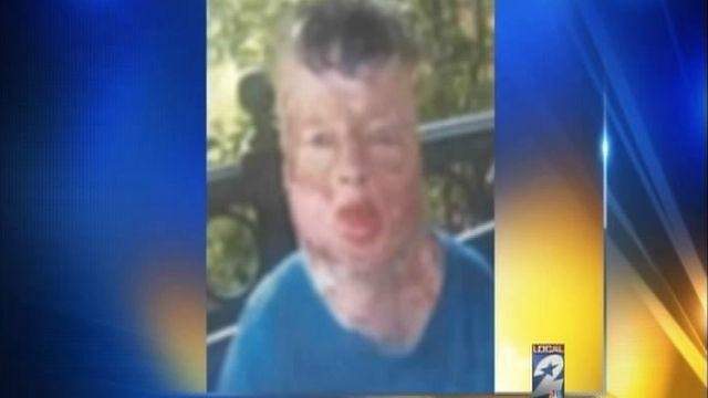 $150 billion awarded to burned boy's family